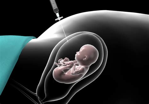 Amnio Genetic Testing Responsibly Ensures The Health And Safety Of A Woman And Her Pregnancy