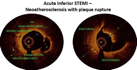 Neo Atherosclerosis With Plaque Rupture Stent Restenosis In Stent