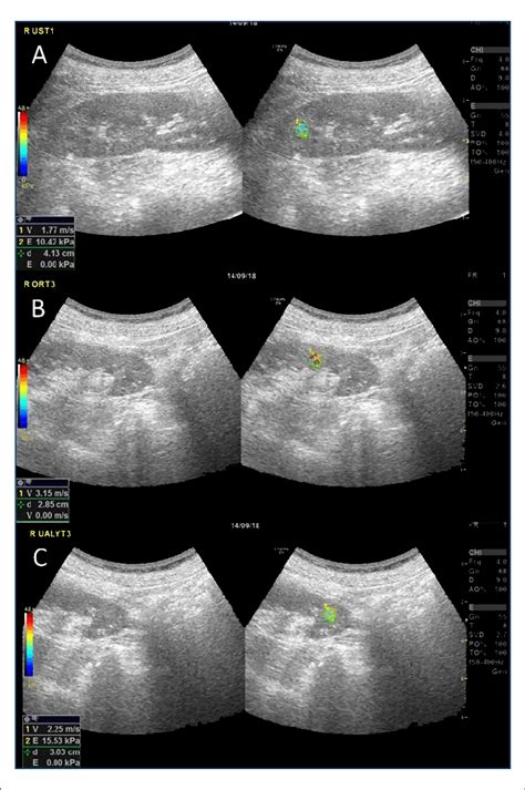 A C Examples Of Shear Wave Elastography Measurements Performed From Download Scientific