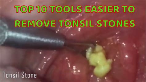 Top 10 Tools Easier To Tonsil Stone Removal Youtube
