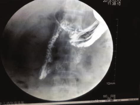 A Linear Foreign Body In The Duodenum Cavity Was Seen In An