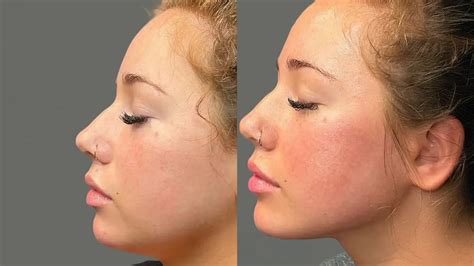 Jawline Contouring Sculpt And Define Your Jaw With Fillers