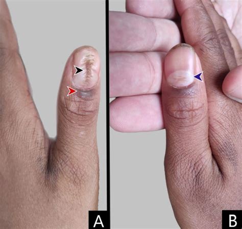 Lichenification Hand