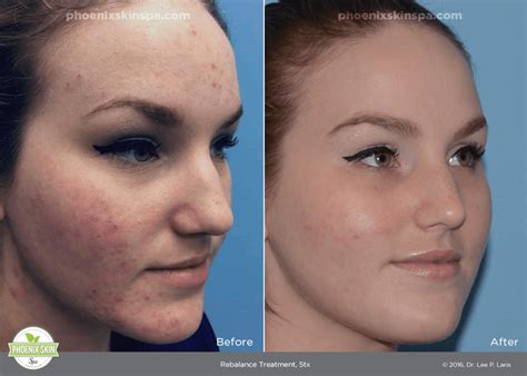 Get Our Blue Red Light Therapy At Phoenix Skin Spa