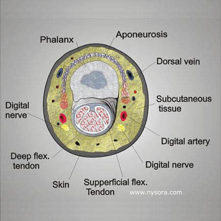 Digital Nerve Block Nysora The New York School Of Regional Anesthesia