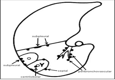 Perilymphatic Pulmonary Nodules Definition Differential Di