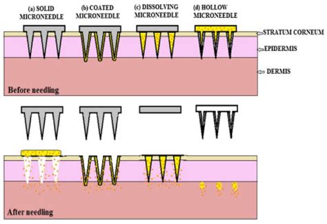 Recent Advancements In Microneedle Technology For Multifaceted