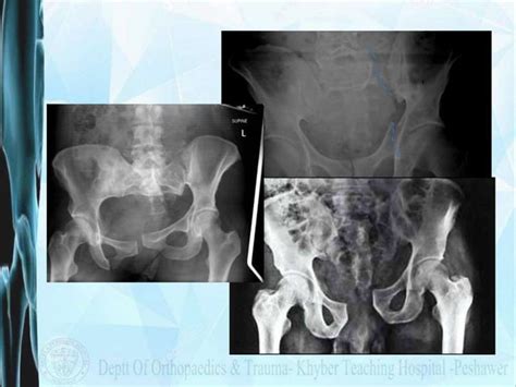 Pelvic Fracture Classification Pptx