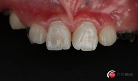 一例上前牙外伤即刻修复 小渡的博客 Kq88口腔博客 一例上前牙外伤即刻修复 小渡的博客 Kq88口腔博客