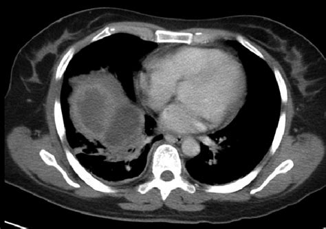 Initial Abdominal Ct Scan Demonstrating Hepatic Abscess Download