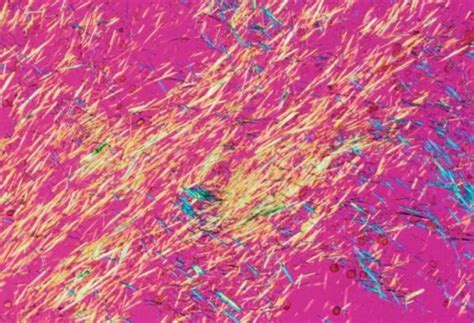 Urate Crystals Goutpal Gout Help