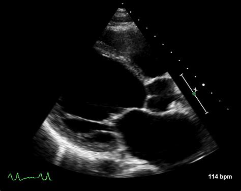 Echocardiogram Heart Failure