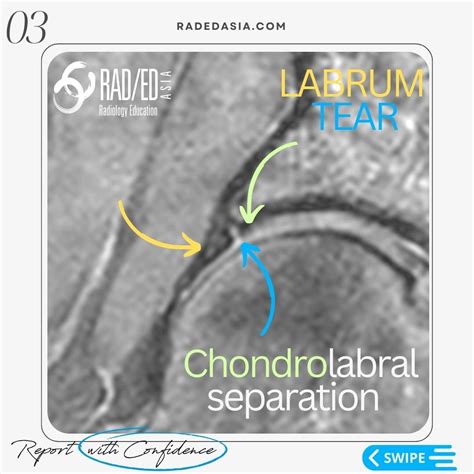 Hip Labrum Labral Tear Mri Radiology Radiology Education Asia