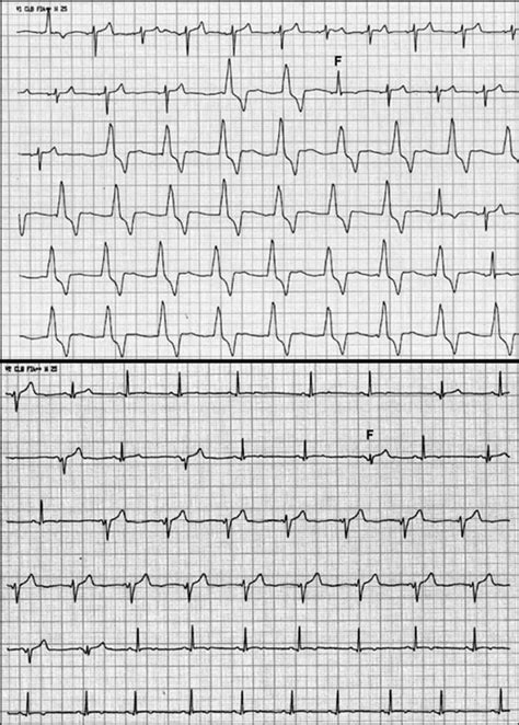 Accelerated Idioventricular Rhythm In The Adult An Update