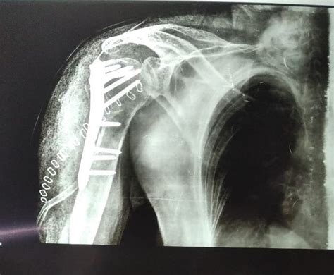 Shoulder Fracture Upper Humerus That Ortho Doctor