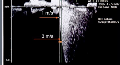 Ventricular Systolic Function Flashcards Quizlet Ventricular Systolic Function Flashcards Quizlet
