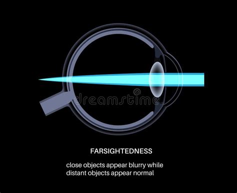 Farsightedness Eye Disease Stock Vector Illustration Of Optic 354013407