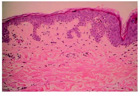 7037bms A 61 Year Old Woman With Rai Stage Iii Chronic Lymphocytic Leukaemia Cll Was