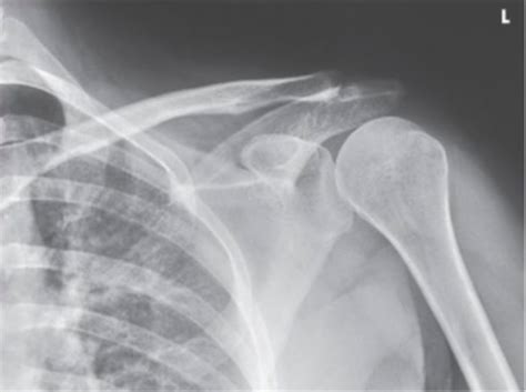 Ap Shoulder Neutral Rotation Diagram Quizlet