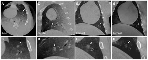 A Novel Method For The Generation Of Realistic Lung Nodules Visualized