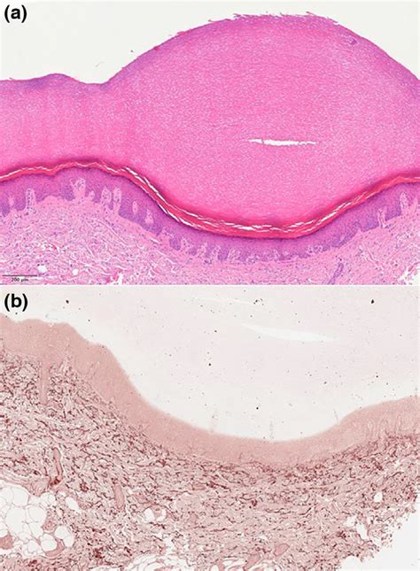 A Histopathology Showing Focal Orthokeratotic Hyperkeratosis With An Download Scientific