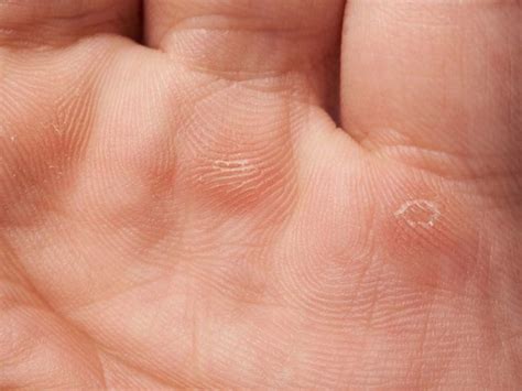 Lichenification Hand