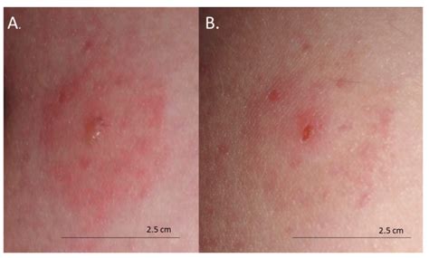 Exposure Of Humans To Attacks By Deer Keds And Consequences Of Their
