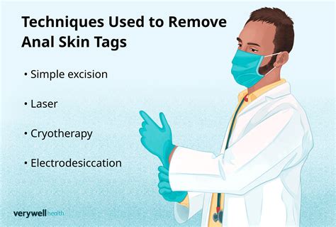 Sentinel Skin Tag Removal