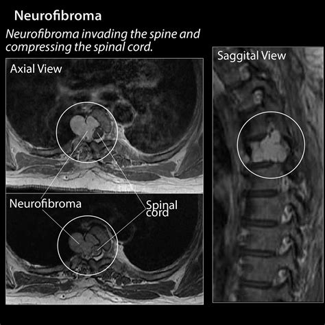Clinical Pathology Glossary Neurofibroma Ditki Medical And Biological Sciences