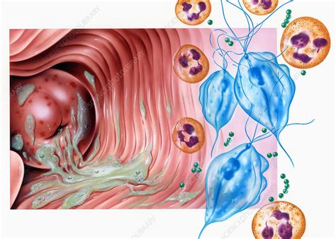 Vaginitis Stock Image M8620073 Science Photo Library
