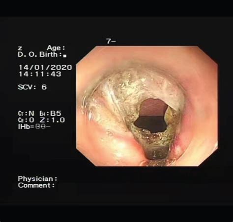 Endoscopic Full Thickness Resection And Endoscopic Closure Procedure