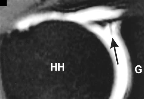 Superior Labral Anteroposterior Tear Classification And Diagnosis On