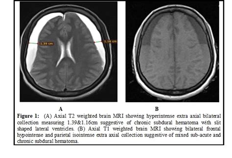 Ajns African Journal Of Neurological Sciences Bilateral Subdural