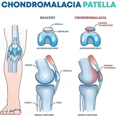 Chondromalacia Patella Definition Softening And Degeneration Of The