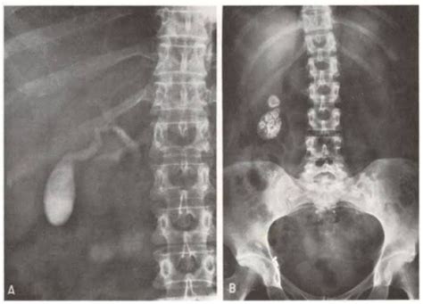 Oral Cholecystography