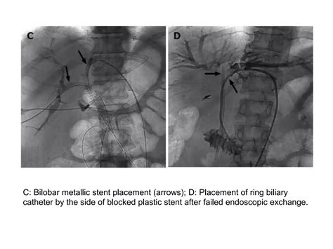 Biliary Drainage Pptx