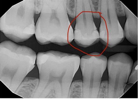 Were These Fillings Improperly Donesealed Raskdentists