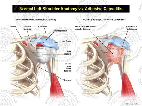 Adhesive Capsulitis Symptoms Capsulite Adhésive Anatomie Bvjh