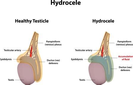 Hydrocele Prevention Home Remedies Useful Yogasanas