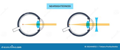 Nearsightedness Eye Disease Vector Illustration 352487198