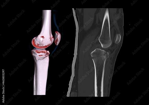 Compare Of Ct Knee Joint 3d Rendering Image Lateral View And Ct Knee 2d