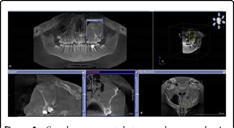 Figure 1 From Maxillary Sinus Abnormalities Detected By Dental Cone Beam Computed Tomography