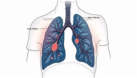 Ct Chest Emphysema Findings Key Indicators And Diagnostic Insights