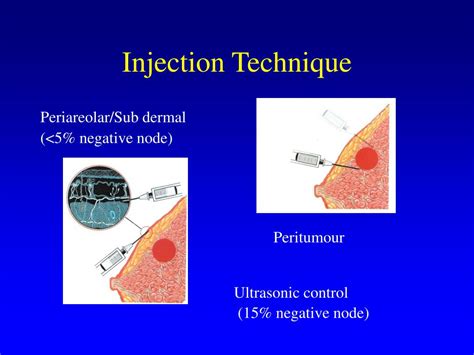 Ppt Sentinel Node Practical Experience At Frimley Park Hospital Powerpoint Presentation Id