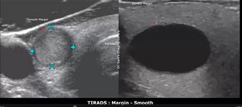 Early Stage Thyroid Cancer Ultrasound Images Tirads Calculator