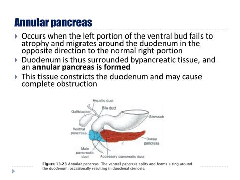 What Is The Classification Of An Annular Pancreas Quizlet At Alfred