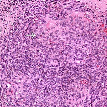 Kaposiform Hemangioendothelioma Basicmedical Key