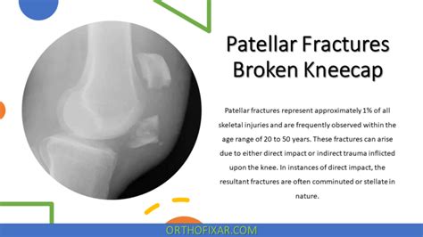 Olecranon Fracture Easy Explained Orthofixar 2026