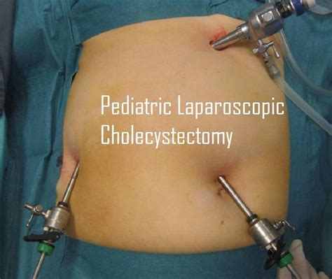 Port Position Of Various Laparoscopic Pediatric Surgeries