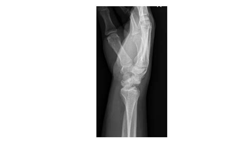 X Ray Wrist Lateral View
